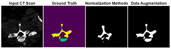 An Automated Deep Learning Approach for Spine Segmentation and ...