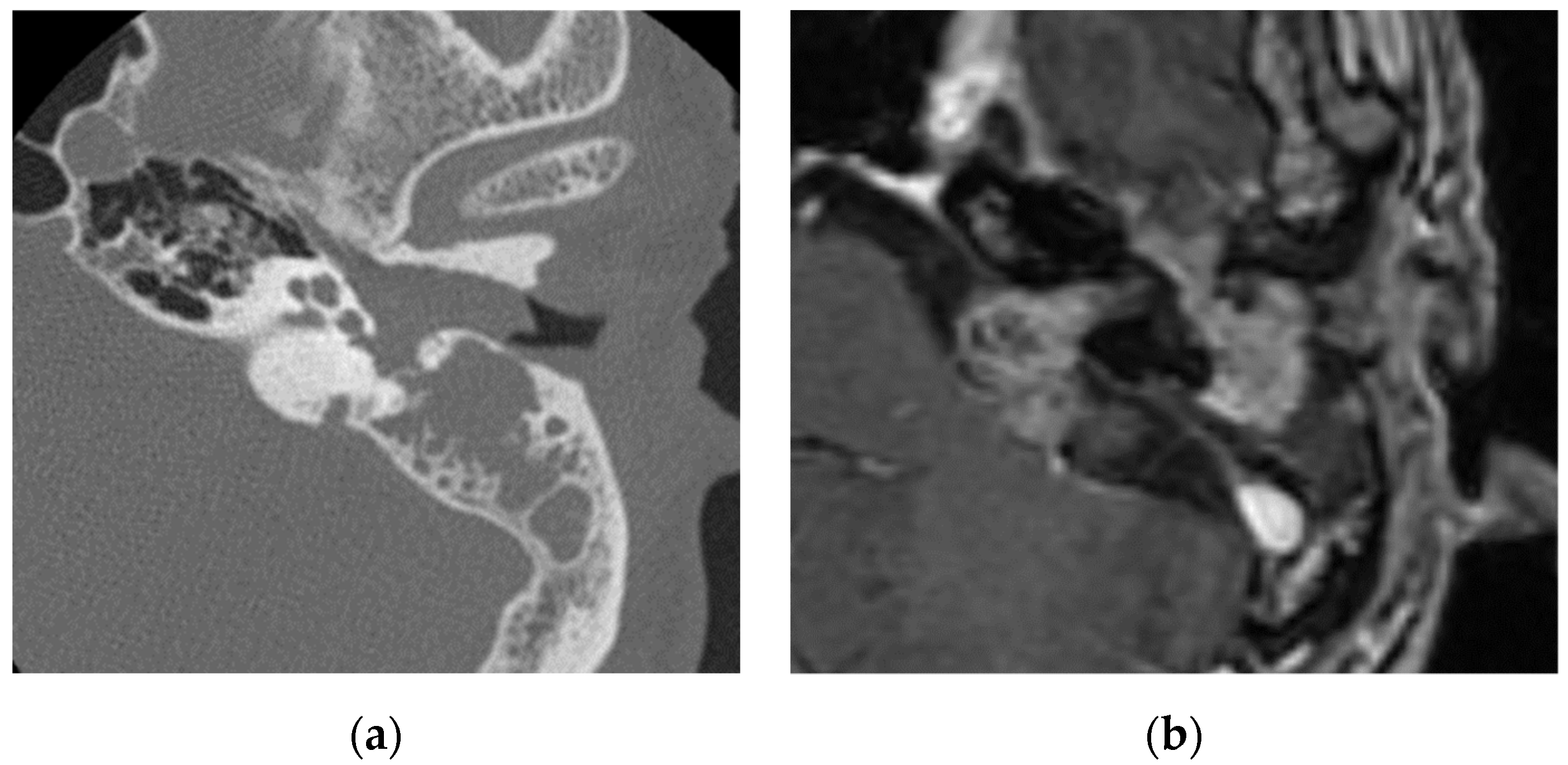Imaging of Temporal Bone Mass Lesions: A Pictorial Review