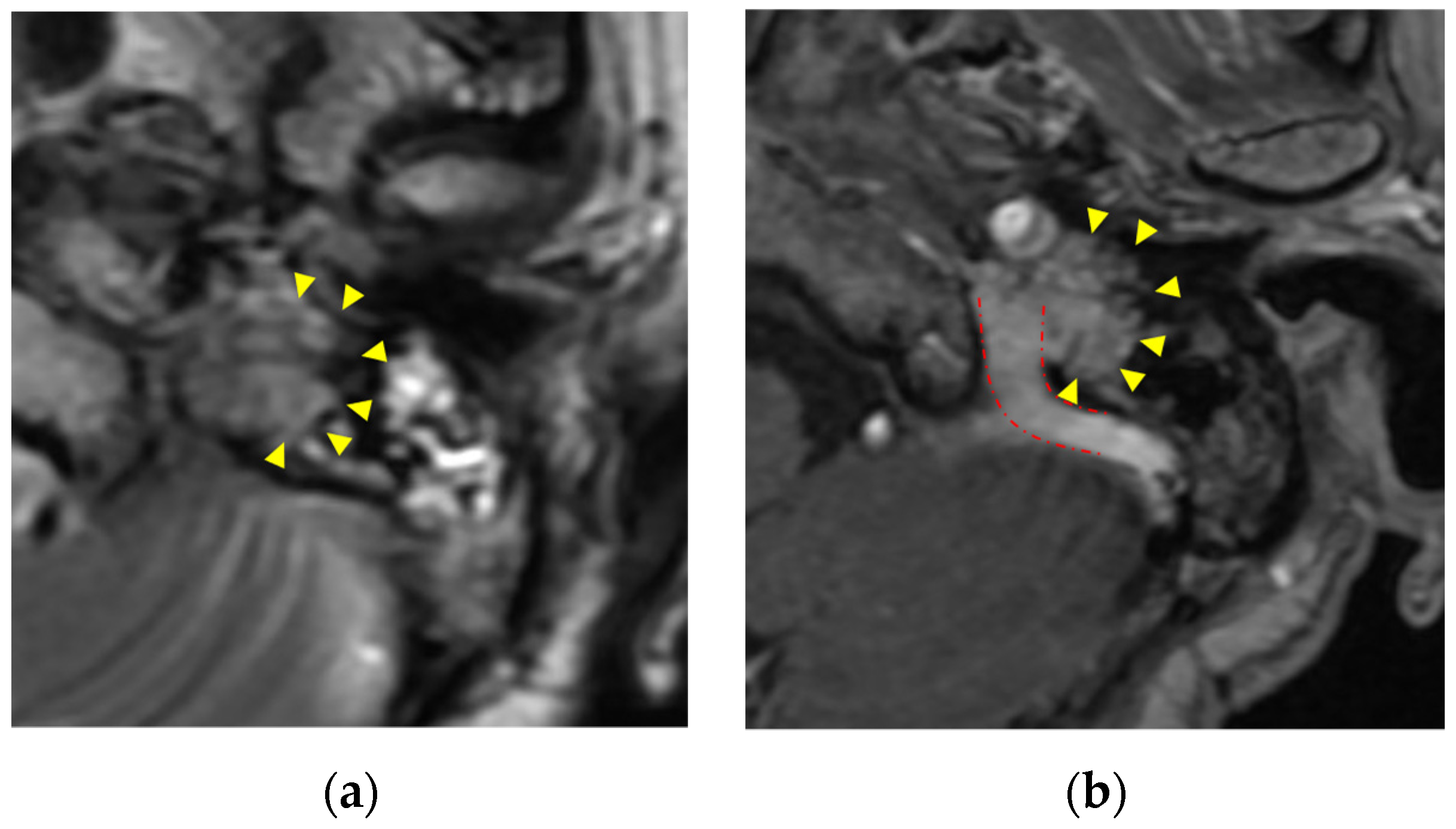 Imaging of Temporal Bone Mass Lesions: A Pictorial Review
