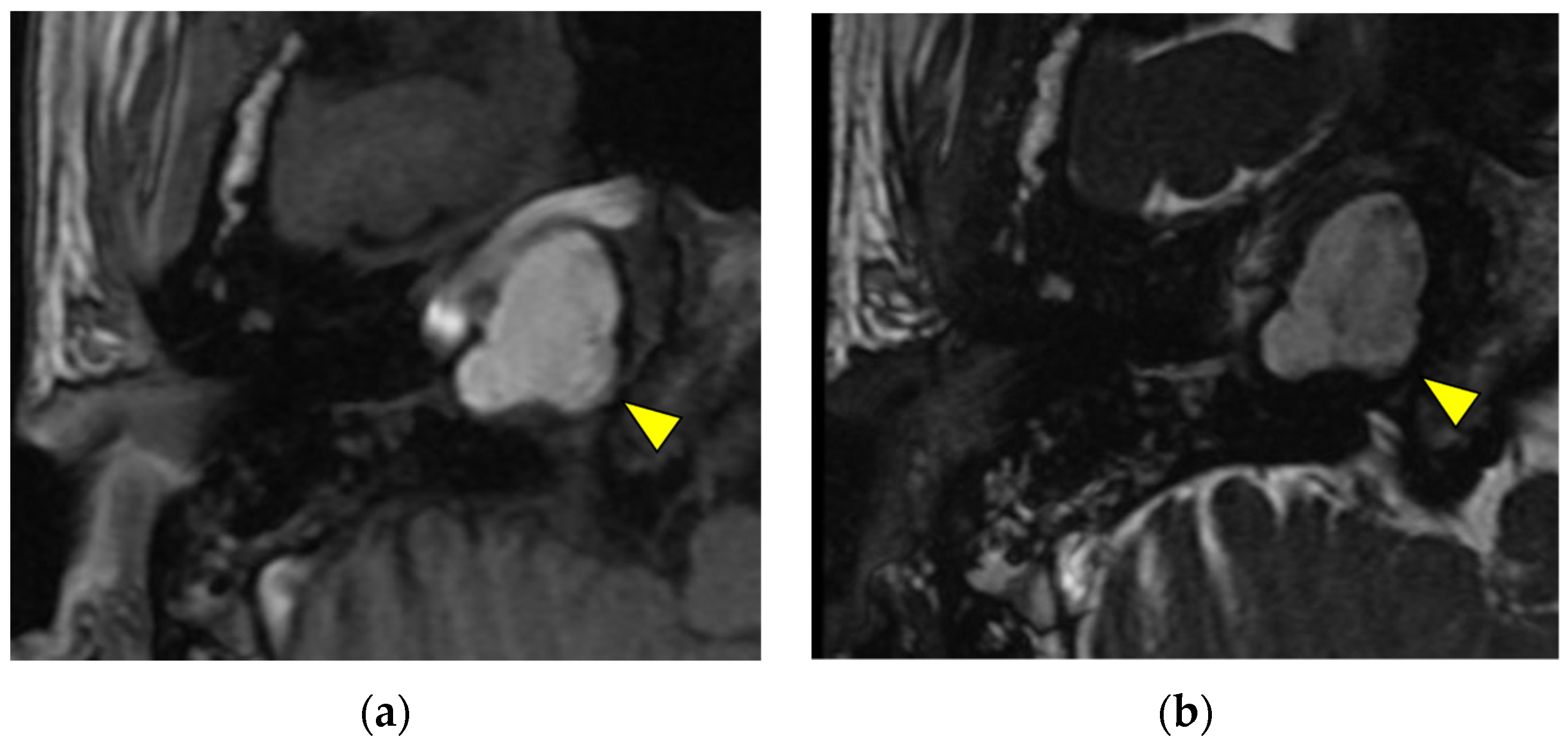 Imaging of Temporal Bone Mass Lesions: A Pictorial Review