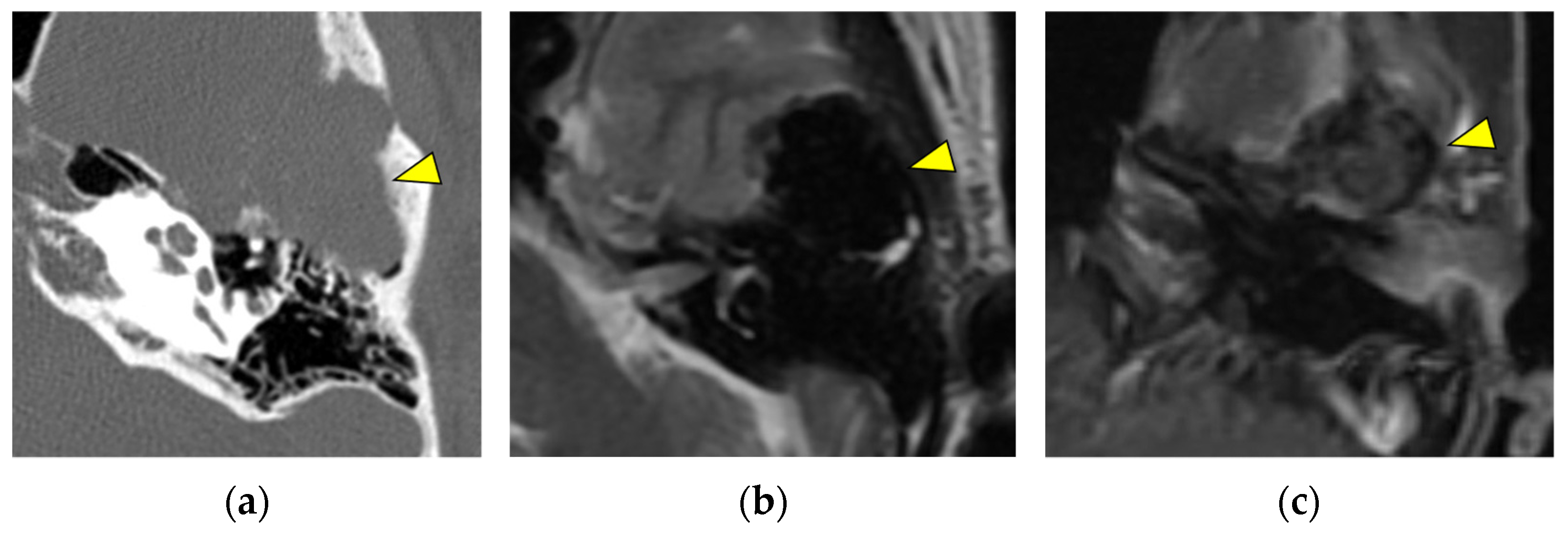 Imaging of Temporal Bone Mass Lesions: A Pictorial Review