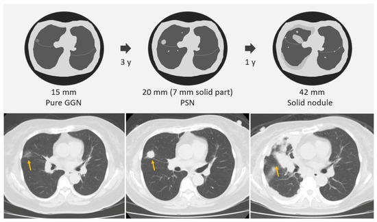 Managing Persistent Subsolid Nodules in Lung Cancer: Education ...