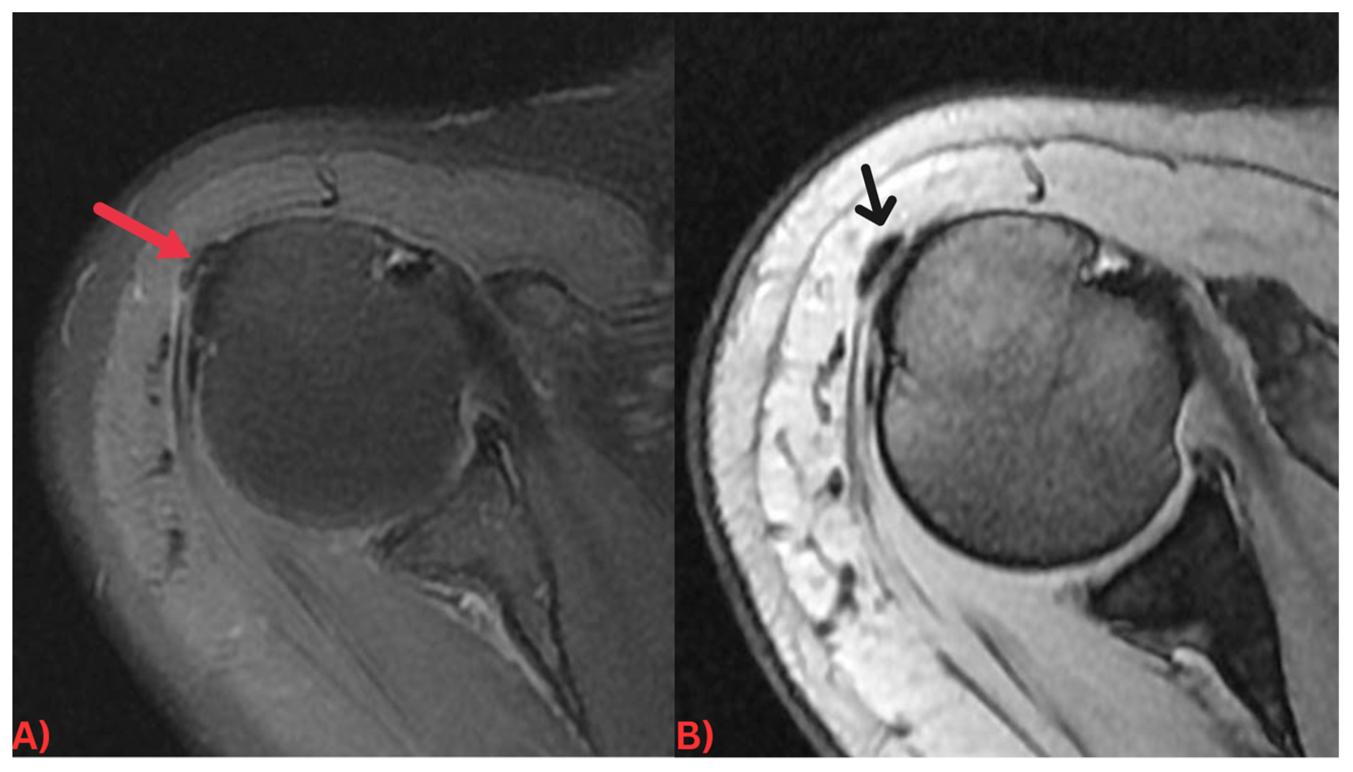Hydroxyapatite Deposition Disease: A Comprehensive Review of ...