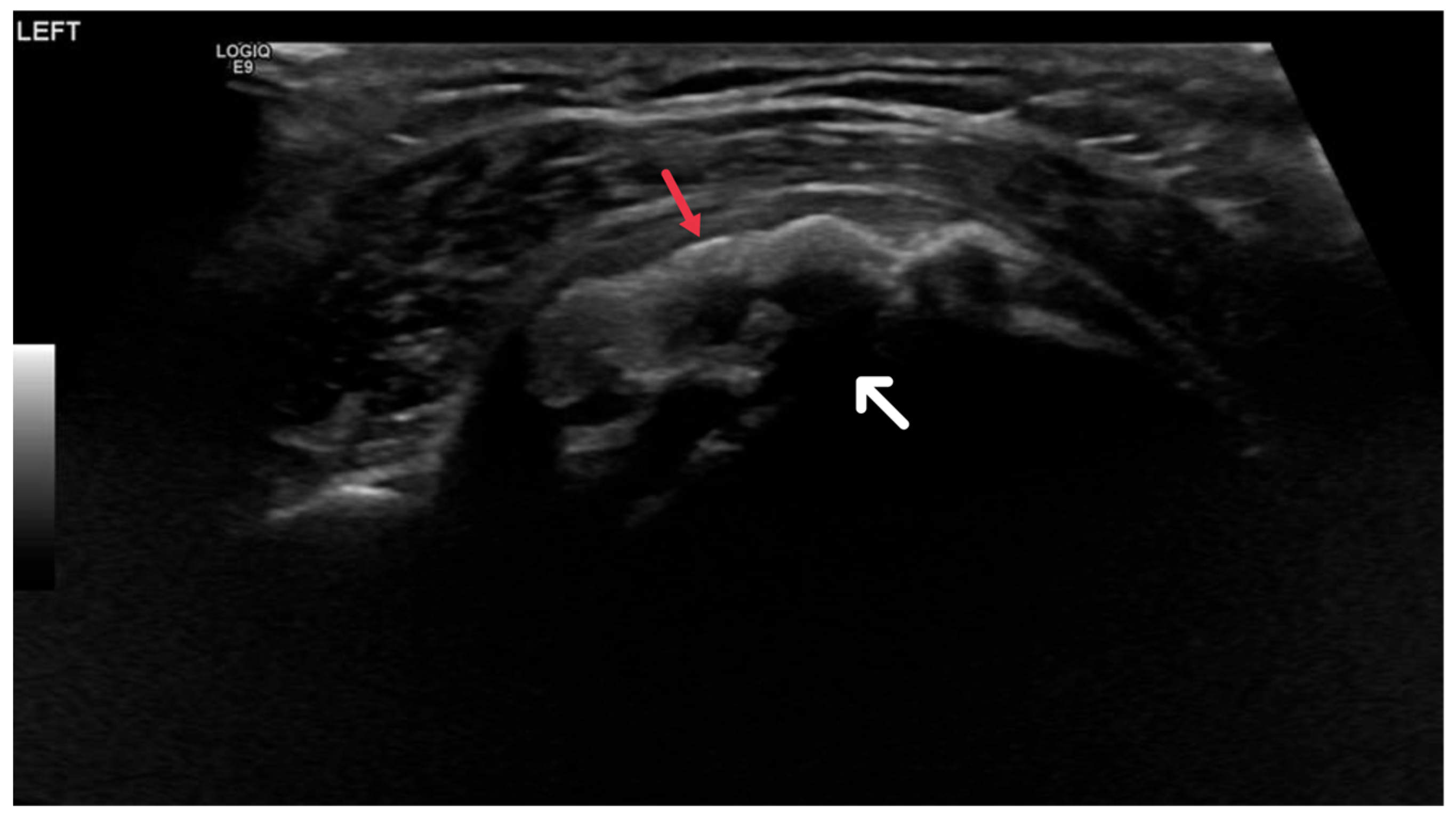 Hydroxyapatite Deposition Disease: A Comprehensive Review of ...