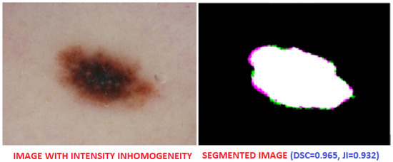 Skin Lesion Segmentation Using an Ensemble of Different Image Processing Methods
