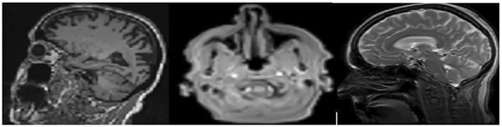 Detection of Alzheimer’s Disease Based on Cloud-Based Deep Learning ...