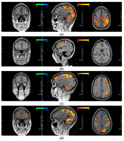 Functional MRI Lateralization [M1] of dlPFC and Implications for ...