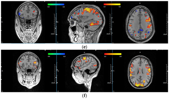 Functional MRI Lateralization [M1] of dlPFC and Implications for ...