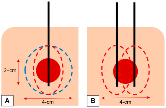 Comparative Study of Ablation Zone of EMPRINT HP Microwave Device with Contemporary 2.4 GHz ...