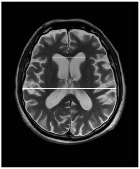 The Role of the Evans Index and the Maximal Width of the Frontal Horns ...