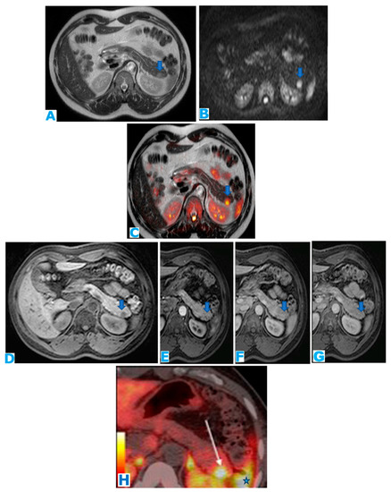 Diagnostics | Free Full-Text | Rare Solid Pancreatic Lesions on Cross ...