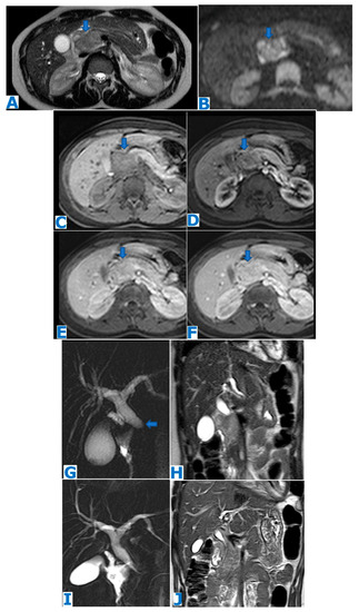 Diagnostics | Free Full-Text | Rare Solid Pancreatic Lesions on Cross ...