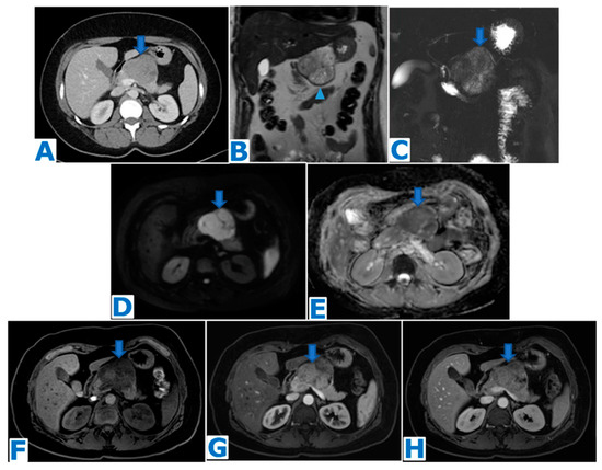 Diagnostics | Free Full-Text | Rare Solid Pancreatic Lesions on Cross ...