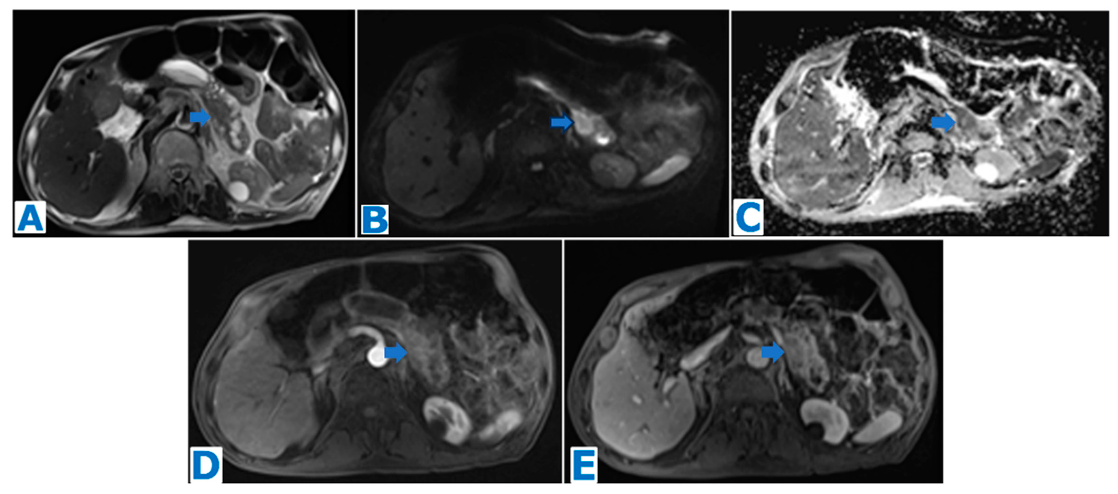 Diagnostics | Free Full-Text | Rare Solid Pancreatic Lesions on Cross ...