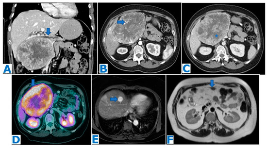 Diagnostics | Free Full-Text | Rare Solid Pancreatic Lesions on Cross ...