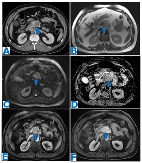 Diagnostics | Free Full-Text | Rare Solid Pancreatic Lesions on Cross ...