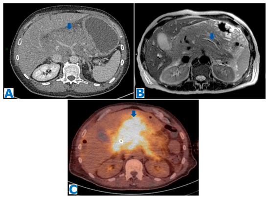 Diagnostics | Free Full-Text | Rare Solid Pancreatic Lesions on Cross ...