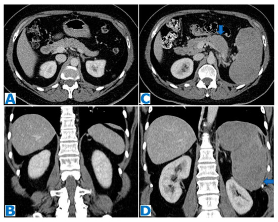 Diagnostics | Free Full-Text | Rare Solid Pancreatic Lesions on Cross ...