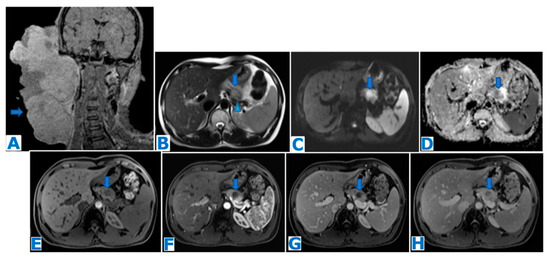 Diagnostics | Free Full-Text | Rare Solid Pancreatic Lesions on Cross ...