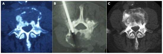 Diagnostic Approach and Differences between Spinal Infections and Tumors