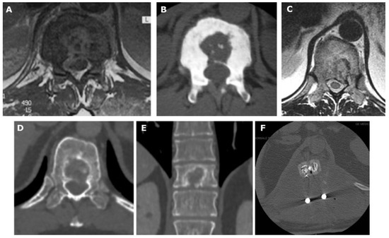 Diagnostic Approach and Differences between Spinal Infections and Tumors