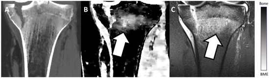 Detecting Bone Marrow Edema of the Extremities on Spectral Computed ...