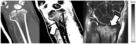 Detecting Bone Marrow Edema of the Extremities on Spectral Computed ...