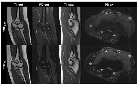 Diagnostics | Free Full-Text | Faster Elbow MRI with Deep Learning ...