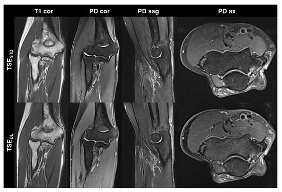 Diagnostics | Free Full-Text | Faster Elbow MRI with Deep Learning ...