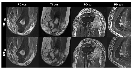 Diagnostics | Free Full-Text | Faster Elbow MRI with Deep Learning ...