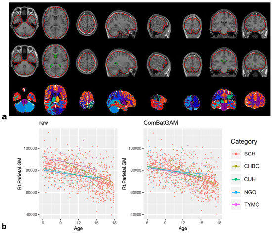 A Brain Morphometry Study with Across-Site Harmonization Using a ComBat-Generalized Additive ...