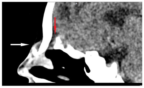 The Differential Diagnosis of Congenital Developmental Midline Nasal ...