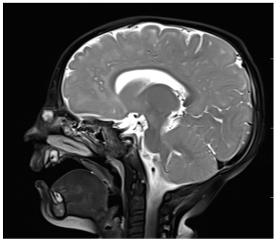 The Differential Diagnosis of Congenital Developmental Midline Nasal ...