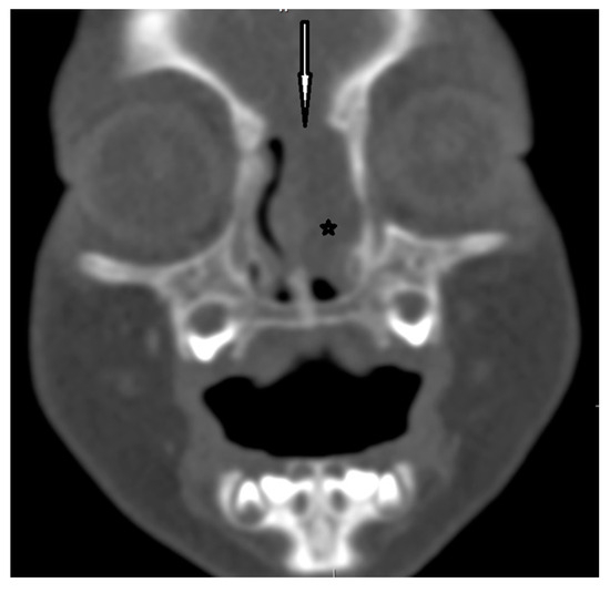 The Differential Diagnosis of Congenital Developmental Midline Nasal ...