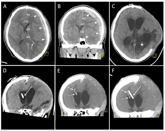 Accuracy, Hemorrhagic Complications and CT Radiation Dose of Emergency ...