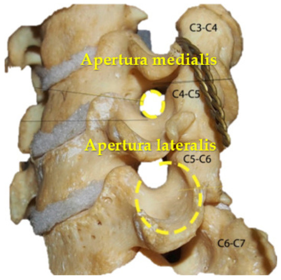 Intervertebral Canals and Intracanal Ligaments as New Terms in ...
