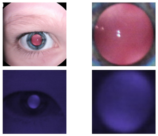 Automatic Refractive Error Estimation Using Deep Learning-Based Analysis of Red Reflex Images