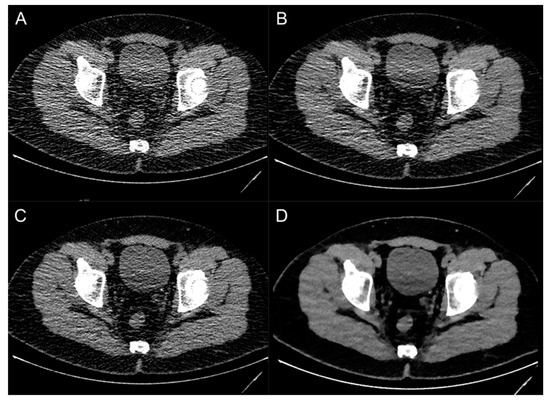 Diagnostics | Free Full-Text | Deep-Learning-Based Image Denoising in Imaging of Urolithiasis ...