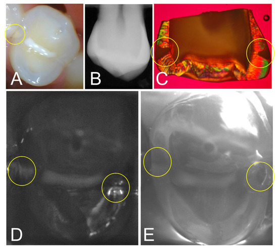 Diagnostic Performance of Multispectral SWIR Transillumination and Reflectance Imaging for ...
