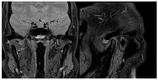 The Role of Temporomandibular Joint Arthroscopy for Diagnosis and ...