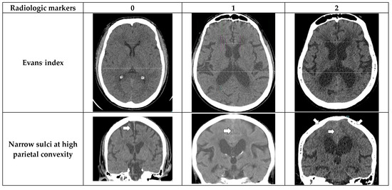 The Diagnostic Accuracy of Artificial Intelligence in Radiological Markers of Normal-Pressure ...