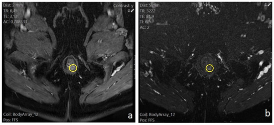 Diagnostics | Free Full-Text | Preoperative Assessment of Perianal ...
