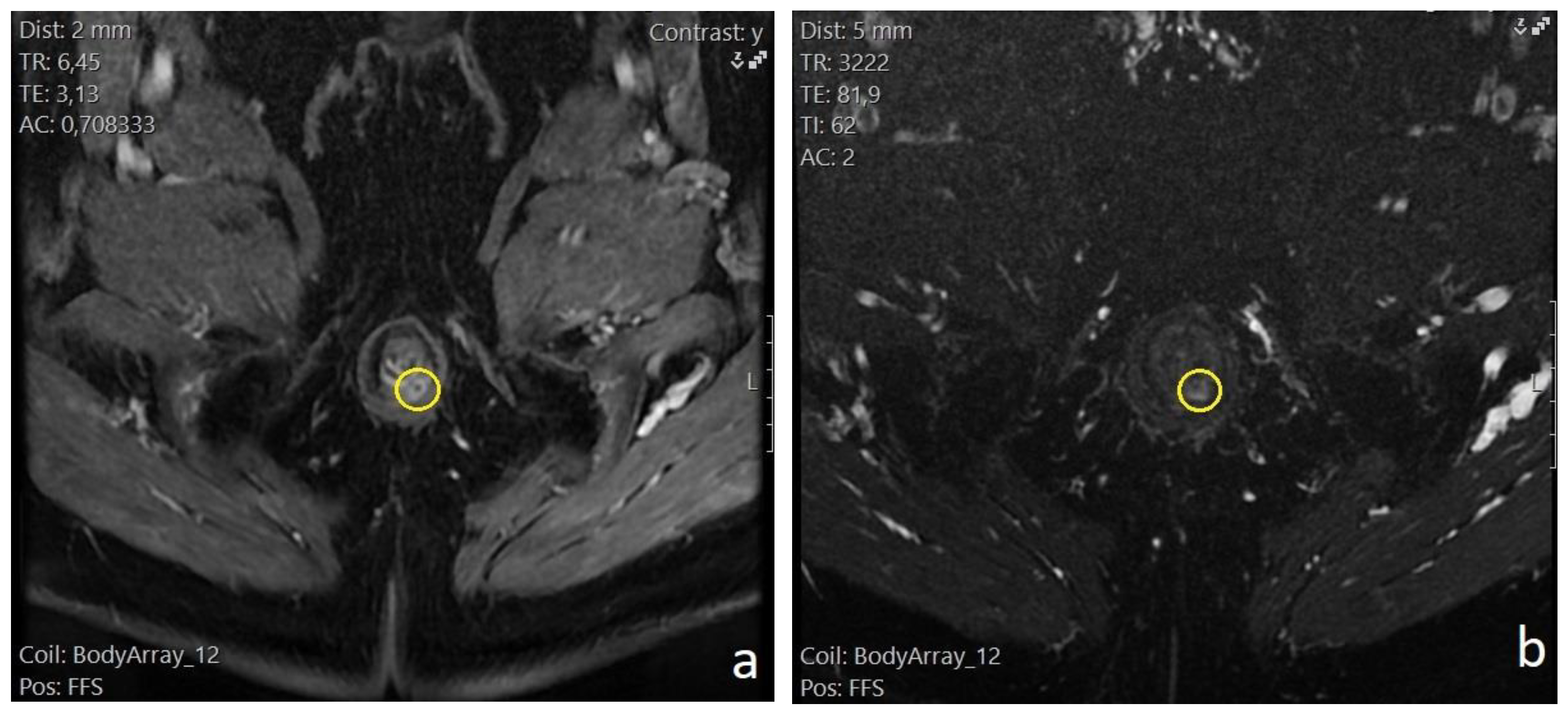 Fistula In Ano Mri