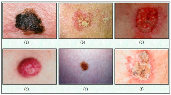 SkinNet-INIO: Multiclass Skin Lesion Localization and Classification Using Fusion-Assisted Deep ...