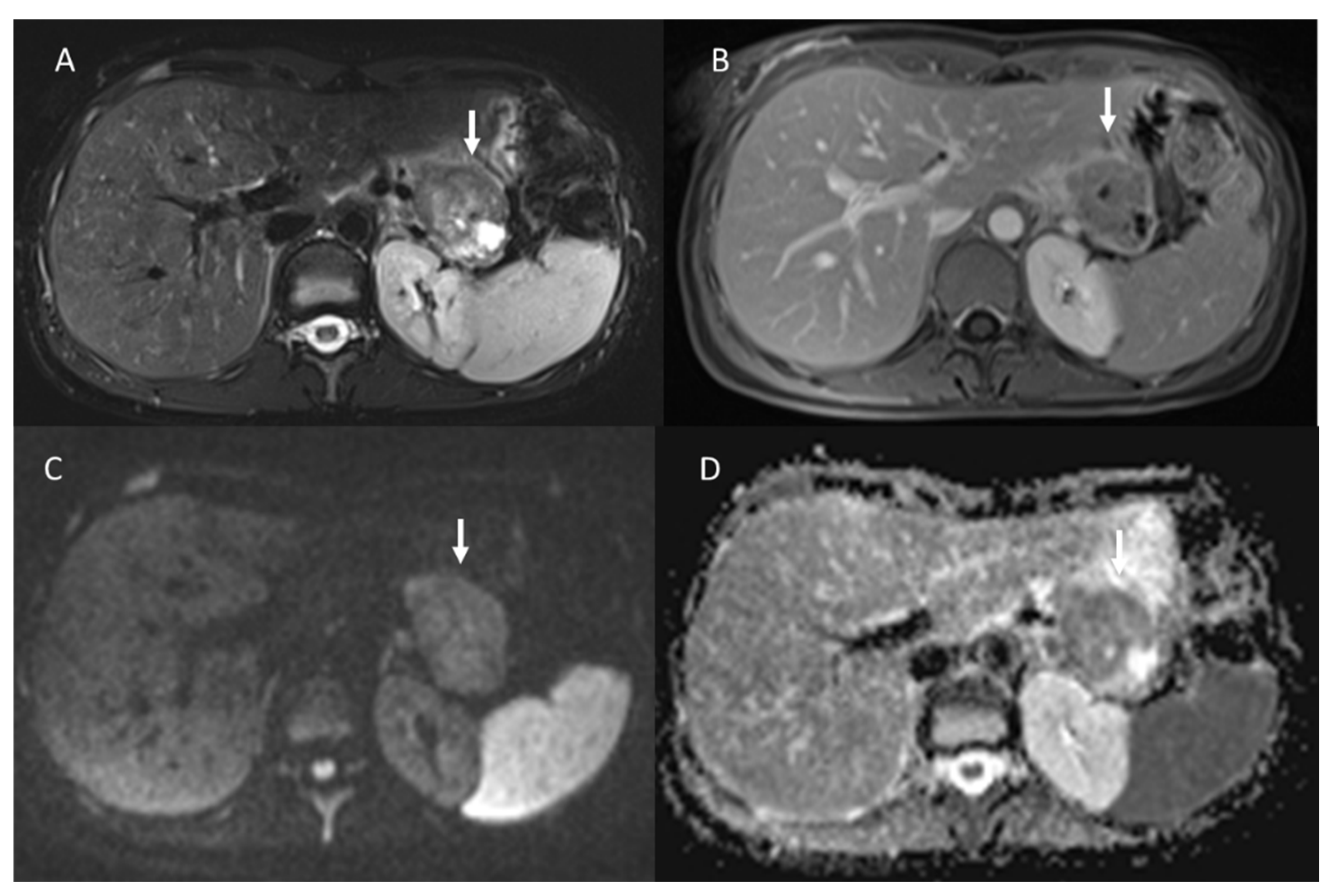 Diagnostics | Free Full-Text | Prognostic Assessment of Gastropancreatic Neuroendocrine Neoplasm ...