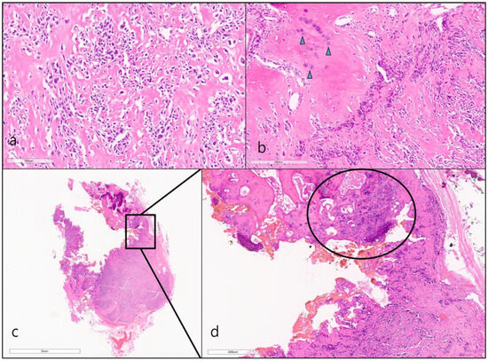 High-Grade Surface Osteosarcoma of the Rib Mimicking a Neurogenic Tumor ...