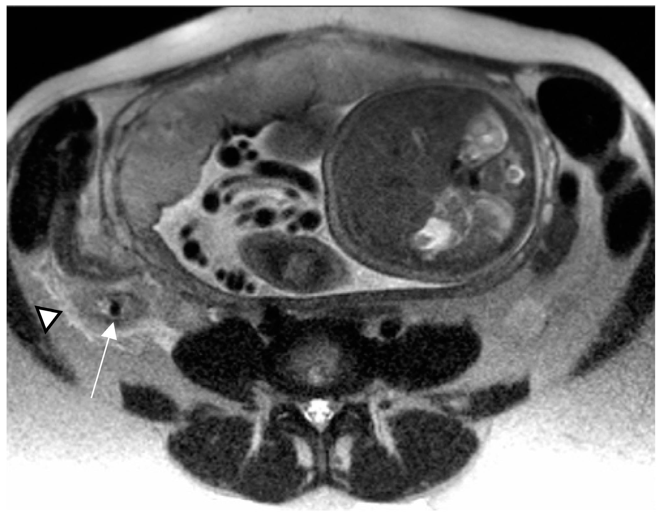Mri Scan Of Acute Appendicitis In A Woman With Right Abdominal Pain At