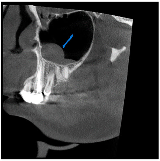 Prevalence of Incidental Maxillary Sinus Anomalies on CBCT Scans: A ...