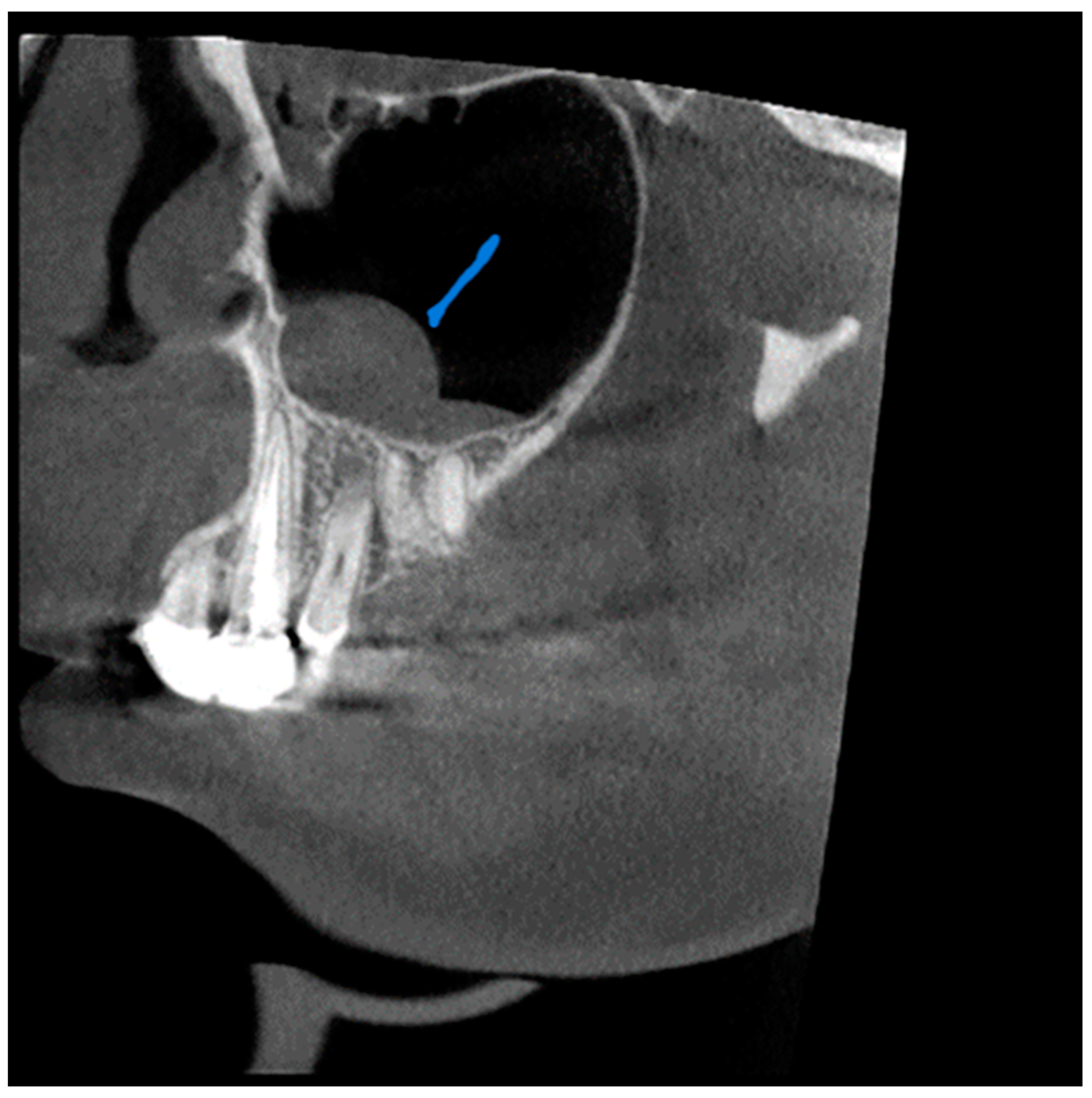 Prevalence of Incidental Maxillary Sinus Anomalies on CBCT Scans: A Radiographic Study