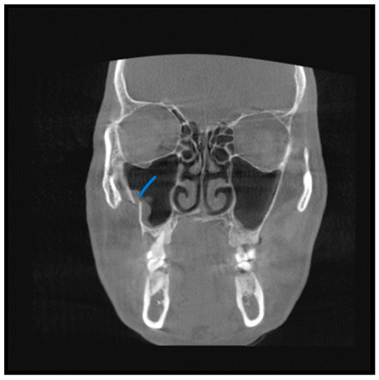 Prevalence of Incidental Maxillary Sinus Anomalies on CBCT Scans: A ...